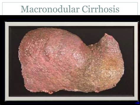 Liver Cirrhosis Pdf