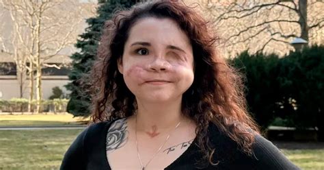 Un Balazo Le Atravesó La Mandíbula Desfigurándole El Rostro Tras 37