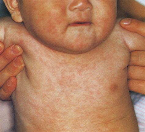 風疹と突発性発疹