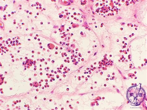 4upper Airway Tract And Larynx 1 Allergic Rhinitispathology Core