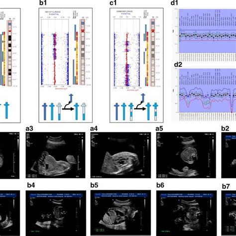 cytogenetic and snp array results of upd combined with chromosomal