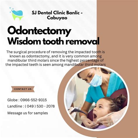 Odontectomy Wisdom Tooth Sj Dental Clinic Cabuyao Facebook