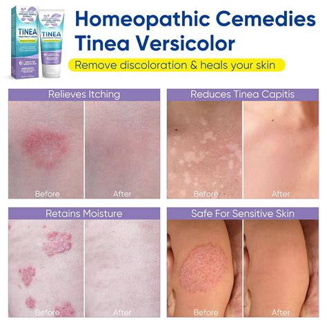 Tinea Versicolor Natural Skin Cream Effective Treatment For All Skin