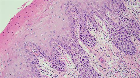 Classic Vulvar Intraepithelial Neoplasia Libre Pathology