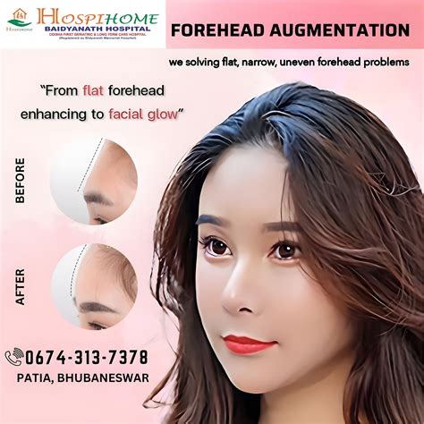Forehead Augmentation We Solving Flat Narrow Uneven Forehead Problems From Flat Forehead