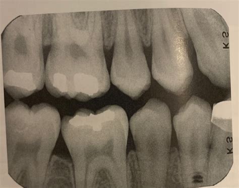 Oral Radiology Bite Wings Flashcards Quizlet