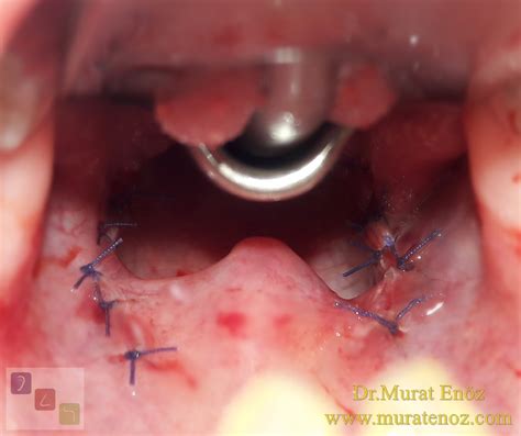 A Few Practical Recommendations To Speed Up Recovery After Tonsillectomy