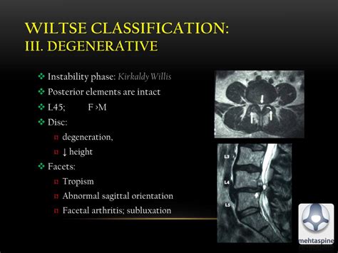 Ppt Spondylolisthesis Powerpoint Presentation Free Download Id1562640