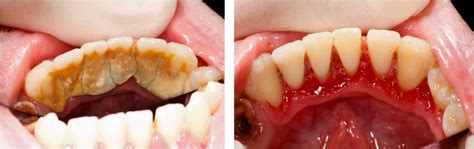 Periodontitis Why Treatment Matters To Your Life