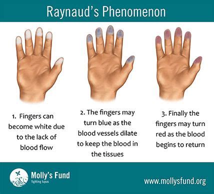 3 72dpi Steps Of Raynauds Raynauds Disease Med Surg Nursing