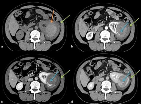 Unusual Rupture Of A Renal Cyst Eurorad