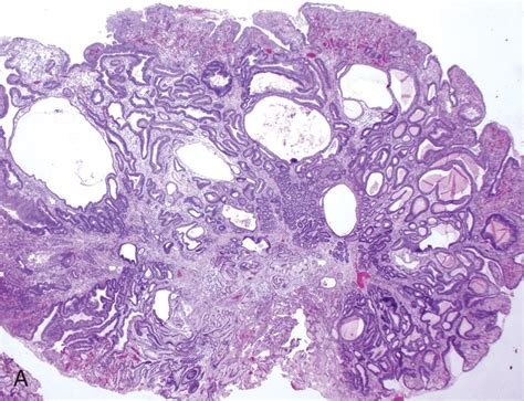 Epithelial Polyps And Neoplasms Of The Stomach Clinical Tree