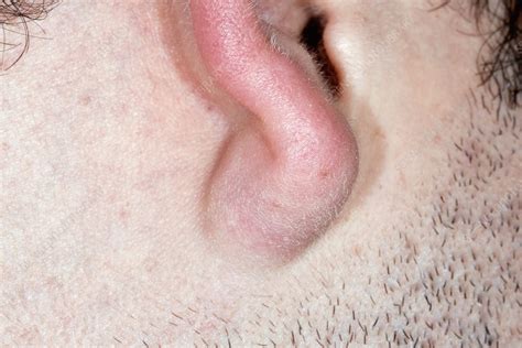 Sebaceous Cyst Stock Image C026 9219 Science Photo Library