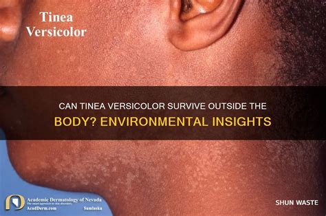 Can Tinea Versicolor Survive Outside The Body Environmental Insights
