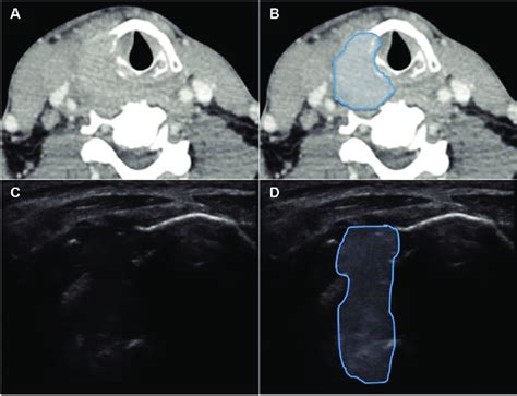 Hypopharynx Larynx Patient 16 A Axial Computed Tomography Ct B