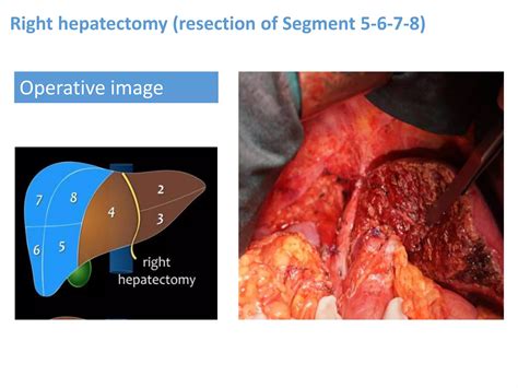 Anatomical Liver Resection Pptx