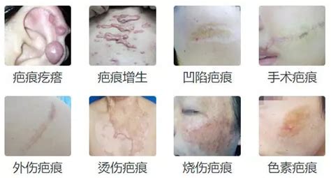 健康学堂】【疤痕科普】祛疤痕先弄清这些事，治疗更有效健康科普排位赛【疤痕】傻大方
