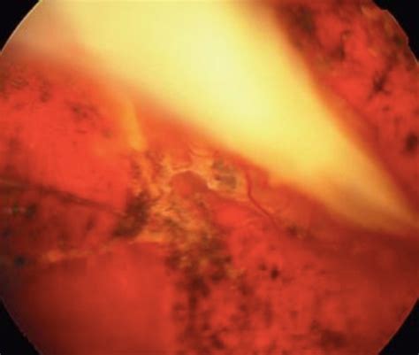 Posterior Uveitis Infectious Conditions Test 4 Flashcards Quizlet