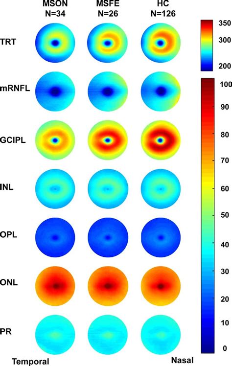 Intraretinal Thickness Maps The Topographic Thickness Of Each Retinal Download Scientific