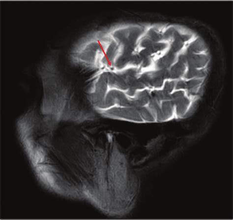 Mri Image Sagittal Section Showing Multiple Gradient Blooming