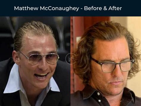 Does Matthew Mcconaughey Have Hair Transplants Zkrju
