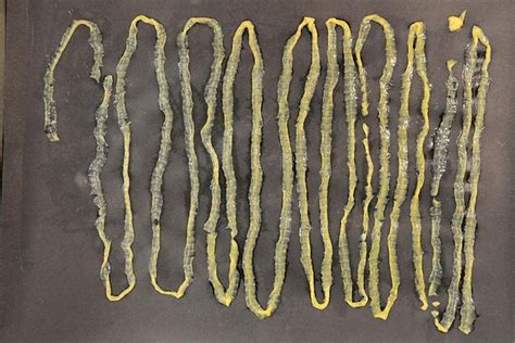 Huge 9ft Tapeworm Removed From A Man In Singapore