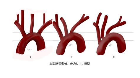 手绘 主动脉弓的形态 脑医汇