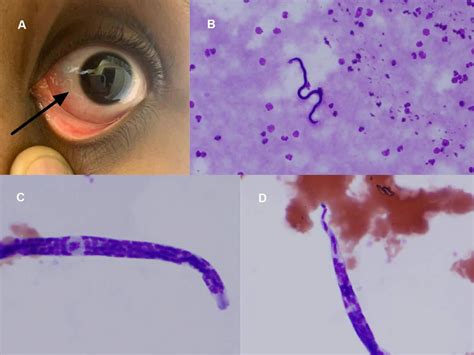 Loiasis African Eye Worm Infection Causes Symptoms Diagnosis