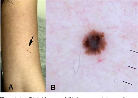 Figure 1 From A Tiny Invasive Melanoma A Case Report With Dermatoscopy