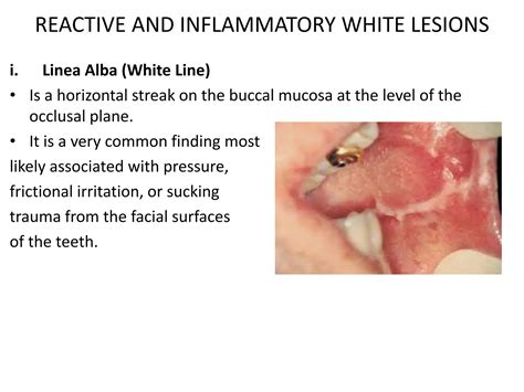 Oral Mucosal Ulceration Pptx