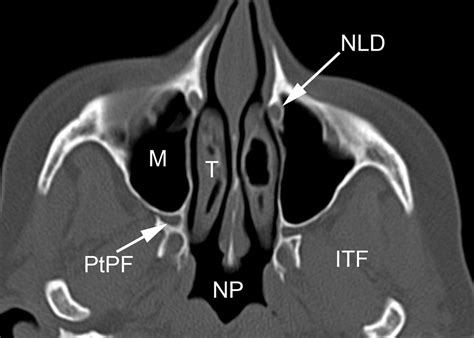 Imaging Of Maxillary Sinusitis Waters View Ct Scan Mri