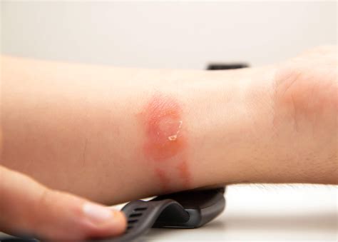 Intertrigo — Brannata Dermatology