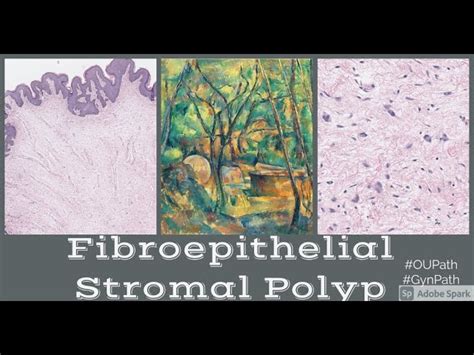 Fibroepithelial Polyp Histology Giant Fibroepithelial Stromal Polyp Of