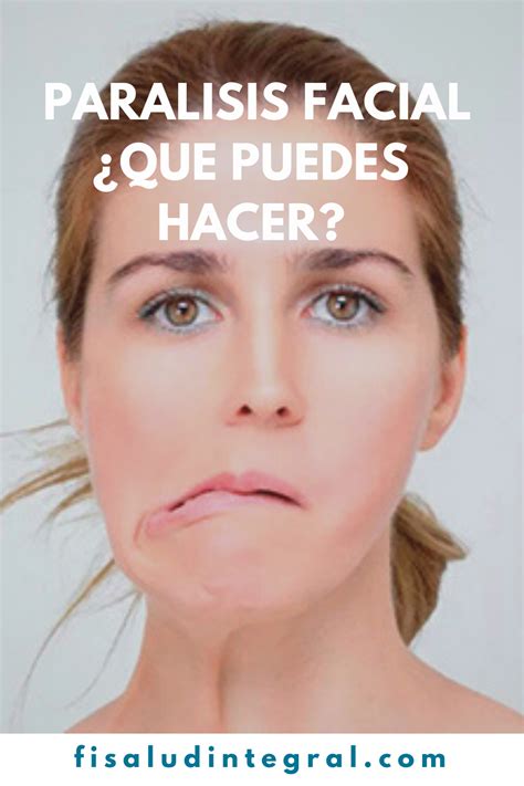 Parálisis Facial Que Puedes Hacer Paralisis Facial Facial