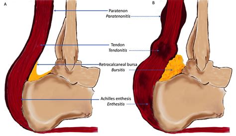 Enthesitis In Spondyloarthritis Including Psoriatic Arthritis—to Inject