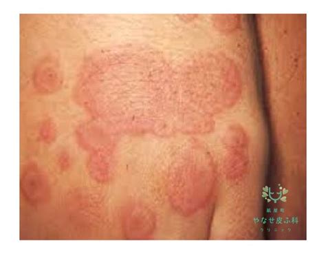 3つの薬疹の分類を写真を基に解説！紙屋町やなせ皮ふ科クリニック｜医療・健康コラム ファミリードクター