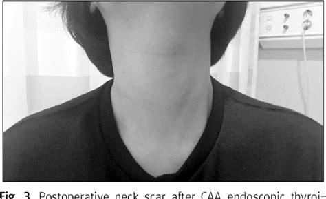 Figure 3 From Endoscopic Thyroidectomy Via The Cervico Axillary