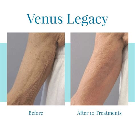 Best Venus Legacy In Buckhead And Alpharetta