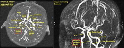 3 D Time Of Flight Spoiled Gradient Recall Tof Spgr Echo Acquisition Download Scientific
