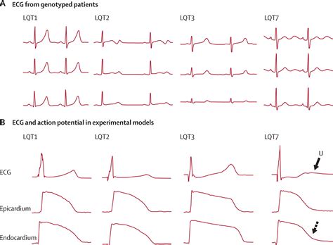 The Qt Syndromes Long And Short The Lancet
