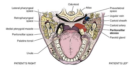 Abscess Near Tonsil At Thomas Marriott Blog