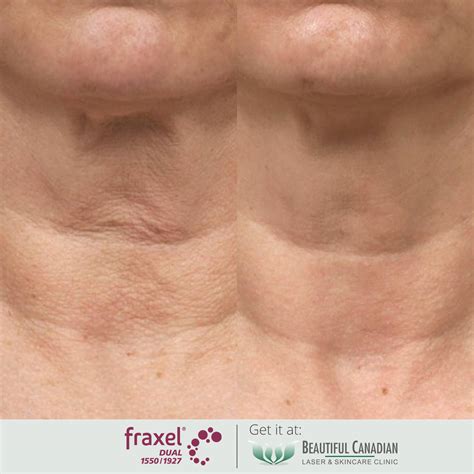 Vancouver Fraxel® Dual Laser In Surrey Skin Tone And Anti Aging