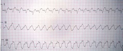 Ventricular Tachycardia Vs Supraventricular Tachycardia