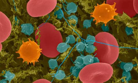 Monocyte Distribution Width May Be Useful Diagnostic Marker For Infection
