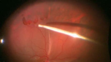Vitrectomy For Rd With Multiple Breaks Using 20k Hypervit Cutter Rd