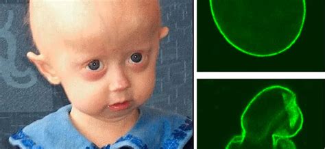 Progeria Causes Symptoms Diagnosis Treatment What Is Progeria