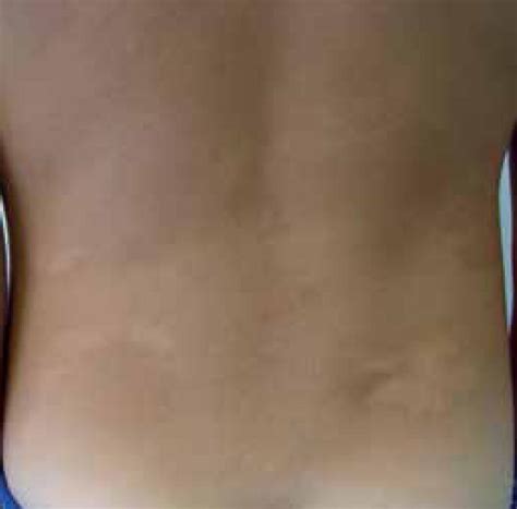 Scielo Brasil Elastoma Clinical And Histopathological Aspects Of A