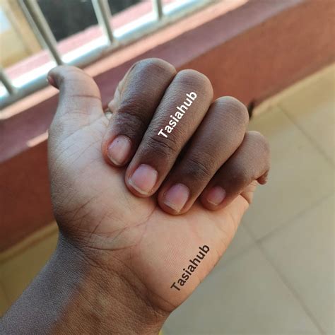 Understanding Onycholysis Of The Nail Causes Symptoms And Treatment