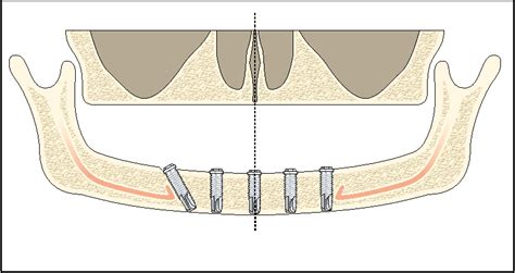 Structure Of Mandibular Nerve Semantic Scholar