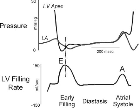 Figure 1 From Is Echocardiographic Evaluation Of Diastolic Function